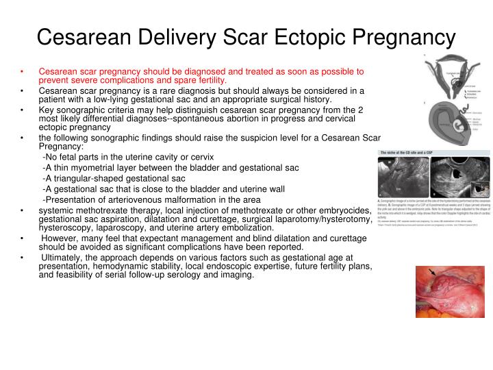 Ppt Cesarean Section Scar Defects Csds Powerpoint Presentation Id