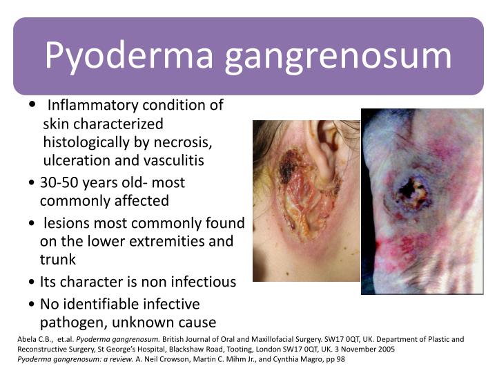 Ppt Pyoderma Gangrenosum Powerpoint Presentation Id 4277662