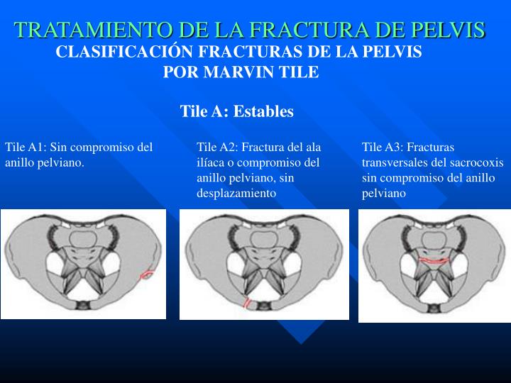 Ppt Tratamiento De La Fractura De Pelvis Powerpoint Presentation Id5349817