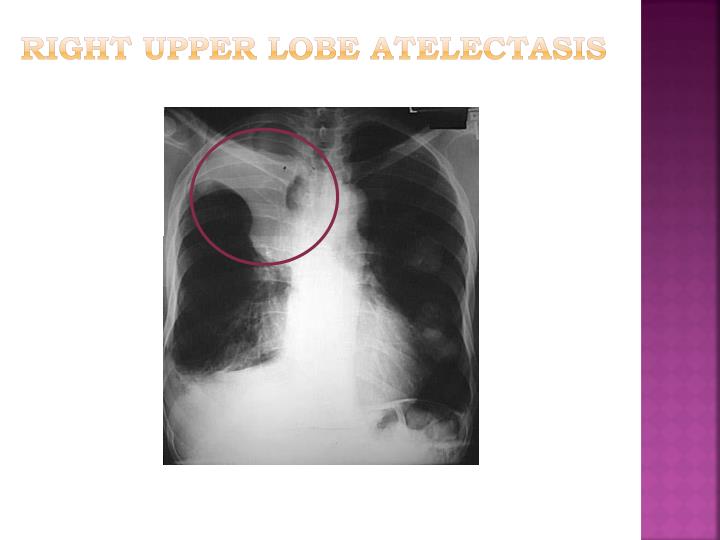 PPT - Atelectasis PowerPoint Presentation - ID:3605018