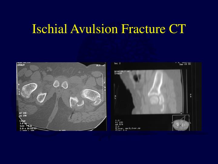 PPT - Fractures of the Pelvis and Acetabulum in Pediatric Patients ...