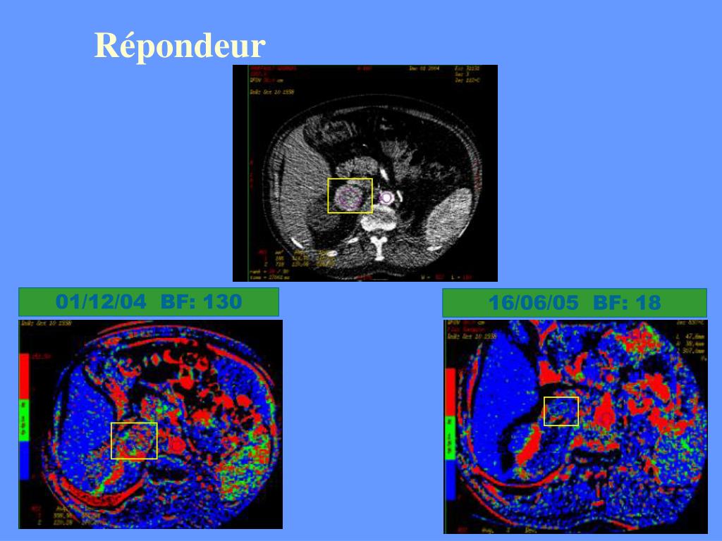 PPT - Imagerie des nouveaux traitements dus cancer du rein métastatique ...