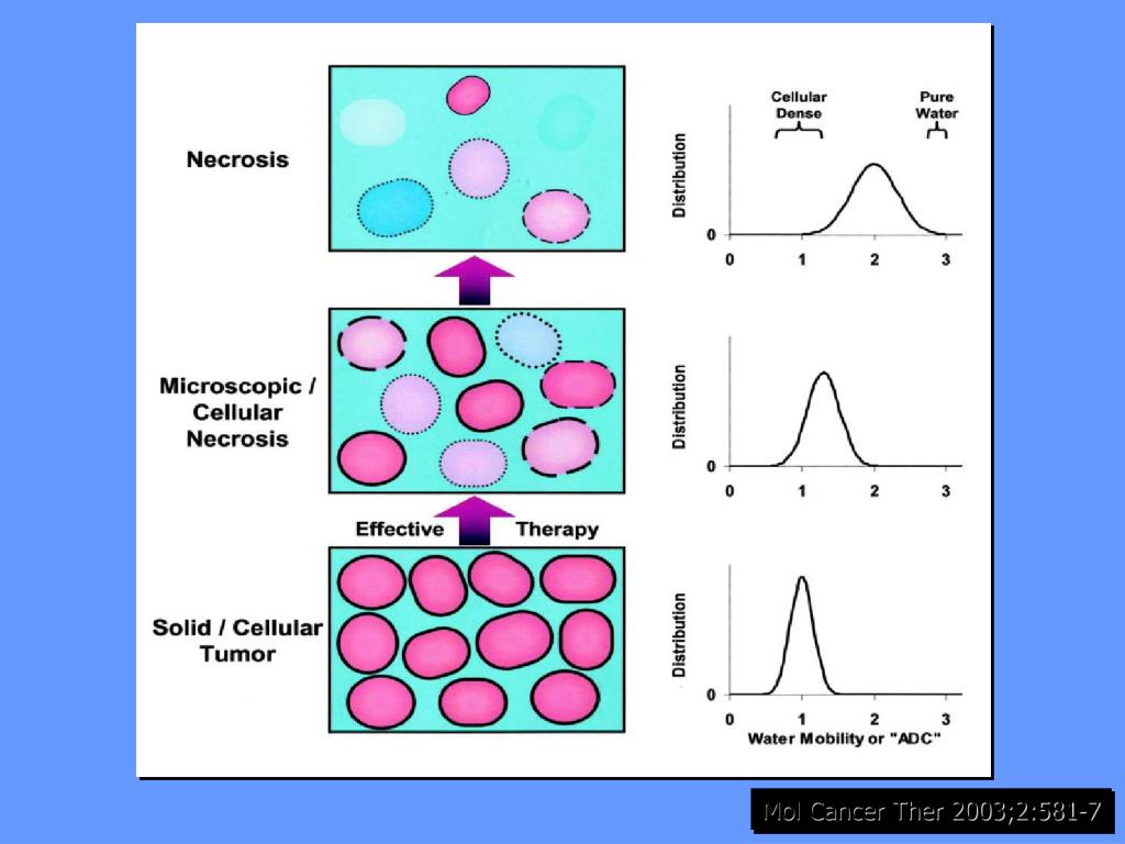 PPT - Imagerie des nouveaux traitements dus cancer du rein métastatique ...