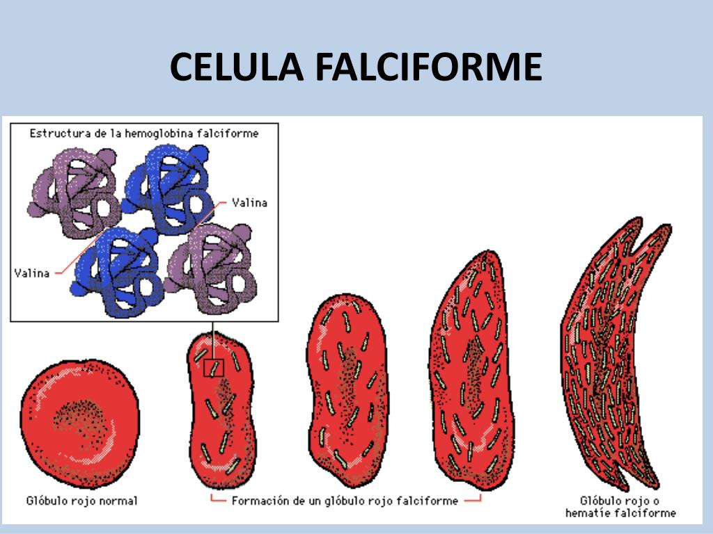 PPT - ANEMIA DREPANOCITICA. ¿SOLO HOSPITALARIA? PowerPoint Presentation ...