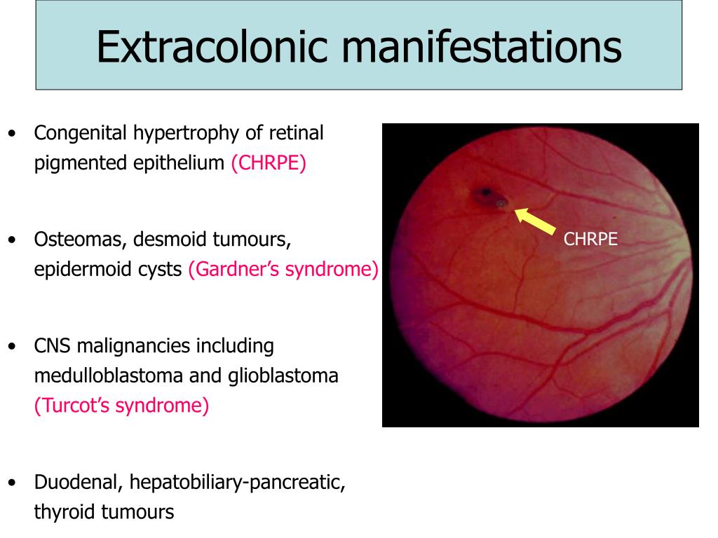 Ppt Colorectal Polyps And Polyposis Syndromes Powerpoint Presentation