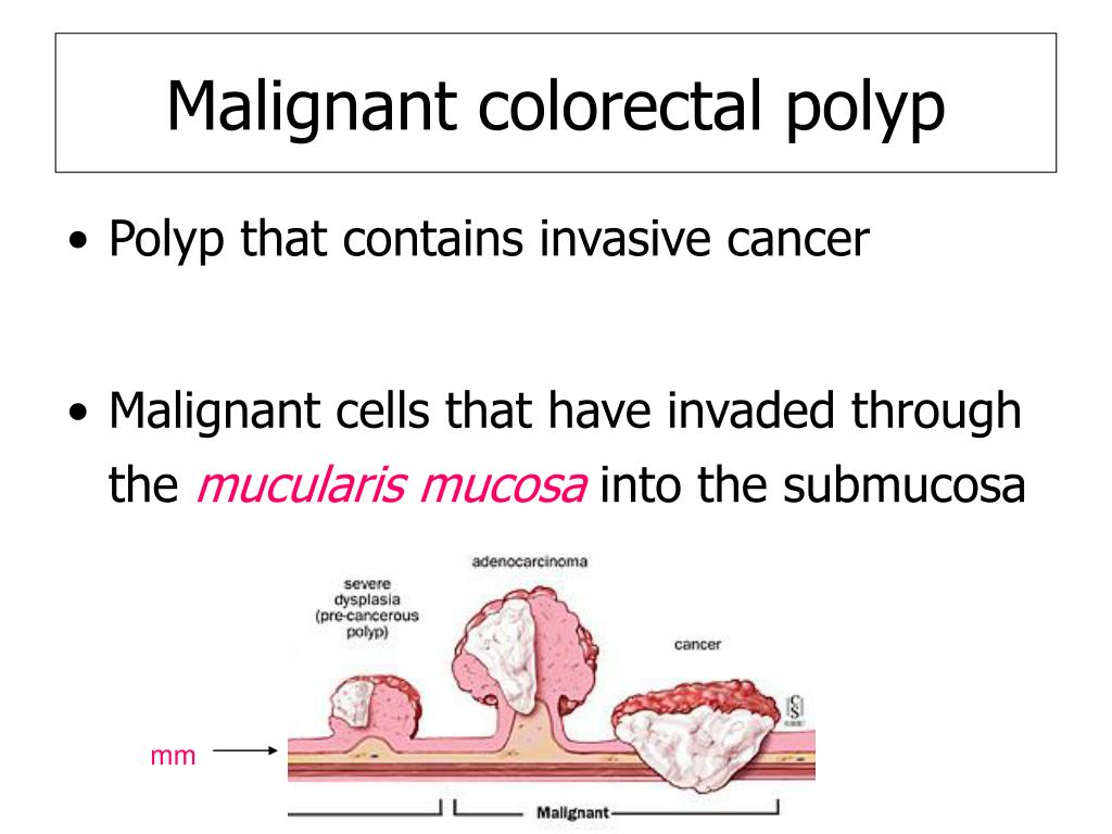 Ppt Colorectal Polyps And Polyposis Syndromes Powerpoint Presentation
