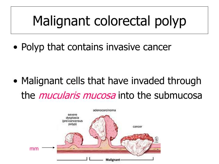 PPT - Colorectal polyps and polyposis syndromes PowerPoint Presentation ...