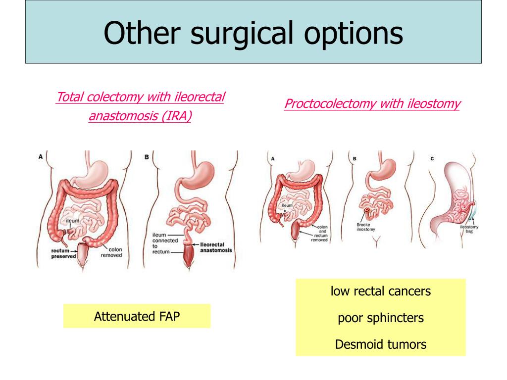 Ppt Colorectal Polyps And Polyposis Syndromes Powerpoint Presentation