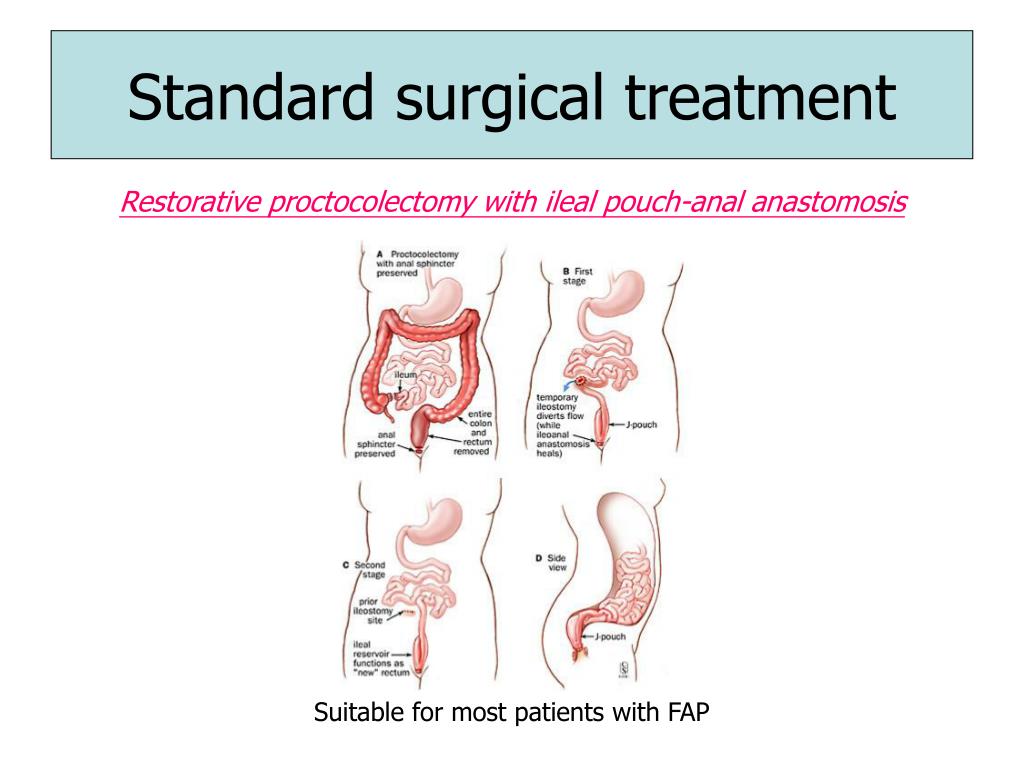 Ppt Colorectal Polyps And Polyposis Syndromes Powerpoint Presentation