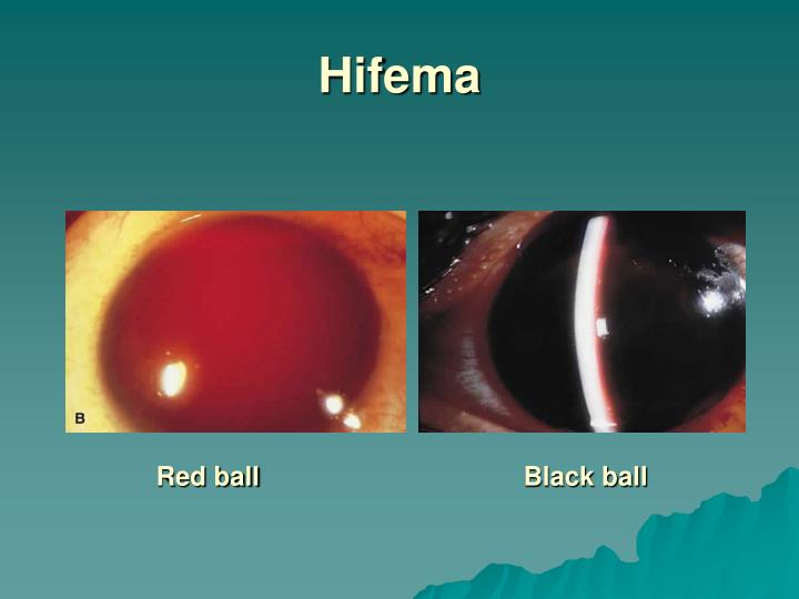 PPT - Trauma ocular PowerPoint Presentation - ID:3635124