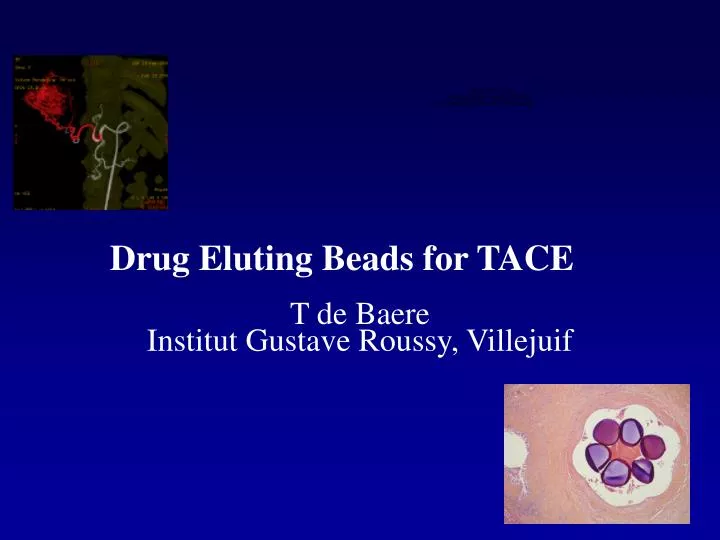 PPT - Drug Eluting Beads for TACE PowerPoint Presentation, free ...
