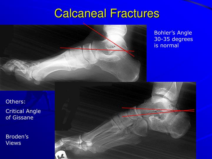 PPT - X-Ray Rounds: (Plain) Radiographic Evaluation of the Ankle ...