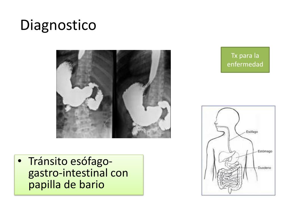 PPT - Trastornos motores del esófago PowerPoint Presentation, free ...