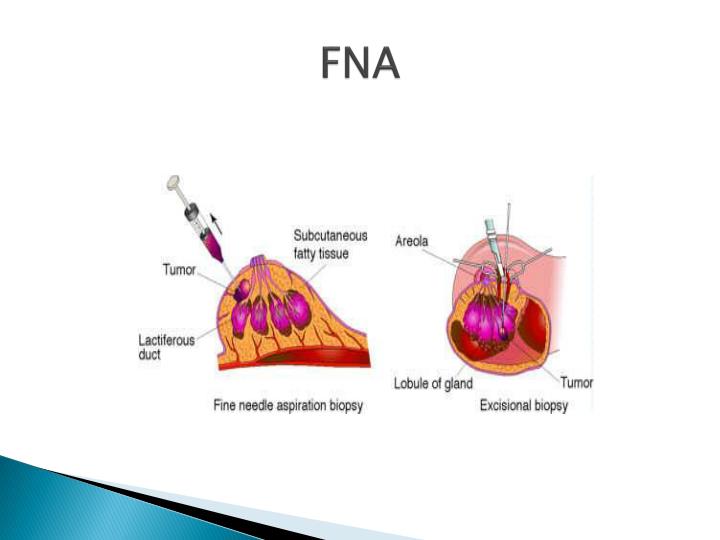 PPT - CLINICAL BREAST EXAM PowerPoint Presentation - ID:3650811