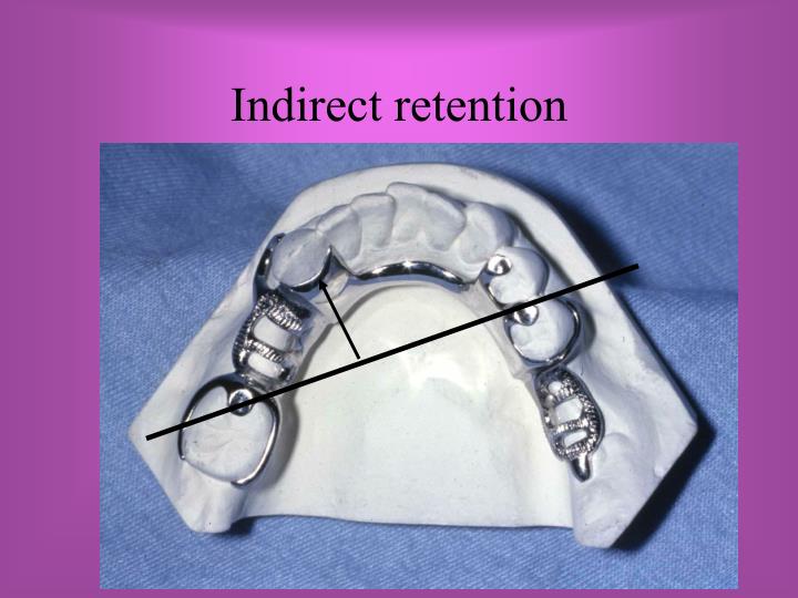 PPT - CLASP RETAINED REMOVABLE PARTIAL DENTURES PowerPoint Presentation ...
