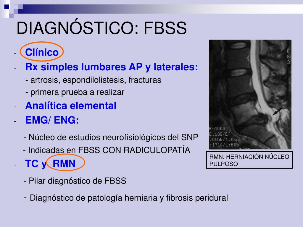 PPT - Dolor lumbar crónico tras cirugía de raquis PowerPoint ...