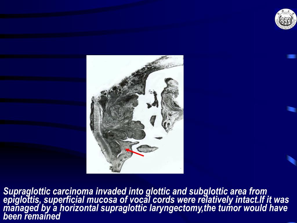 PPT - 贯声门癌组织病理学研究和临床 Histopathological Research of Transglottic ...