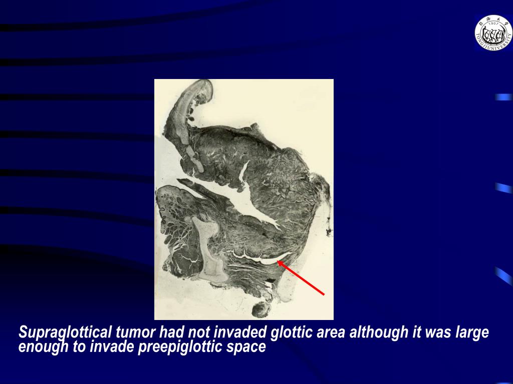 PPT - 贯声门癌组织病理学研究和临床 Histopathological Research of Transglottic ...