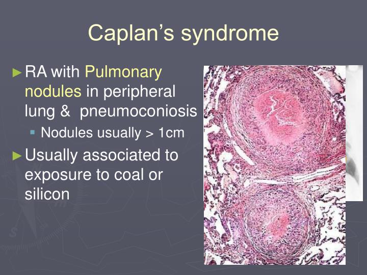 PPT - 類風濕關節炎 PowerPoint Presentation - ID:3662086