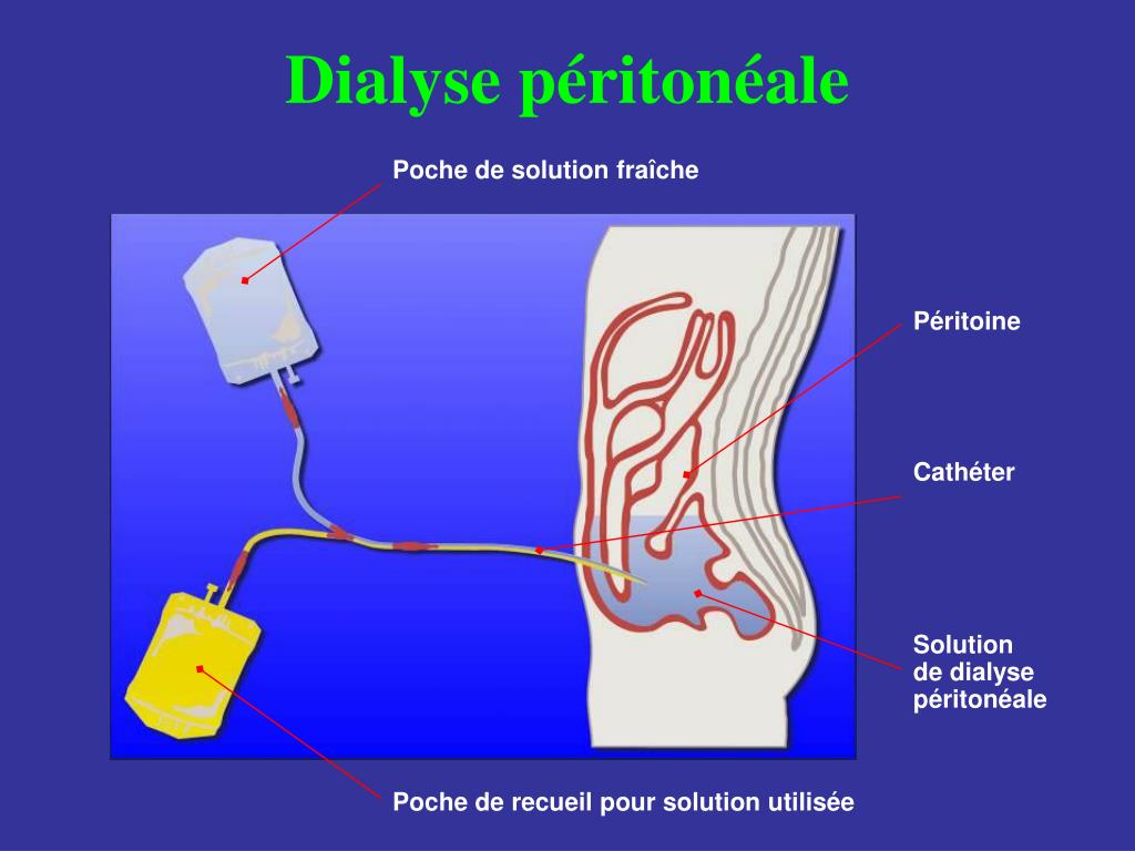 Ppt La Dialyse Péritonéale Powerpoint Presentation Free Download