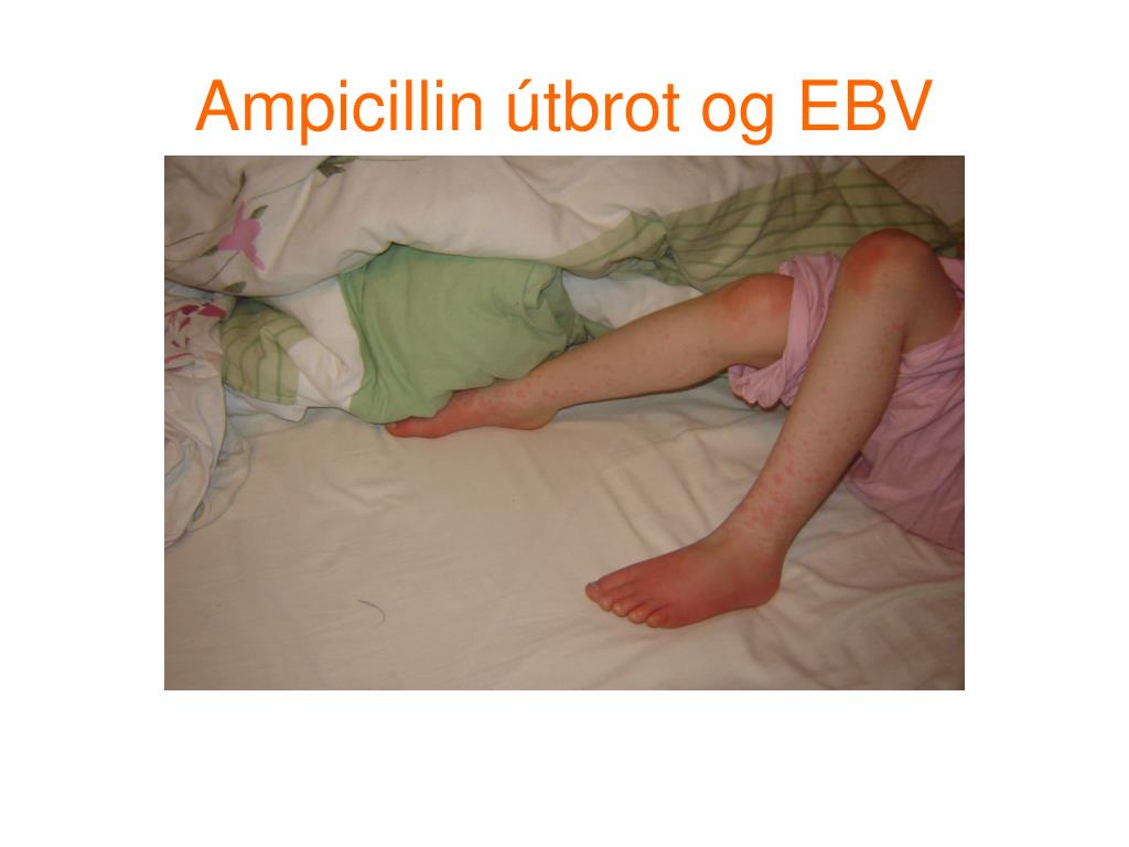 PPT - Ýmsir smitsjúkdómar og bólusetningar PowerPoint Presentation - ID ...