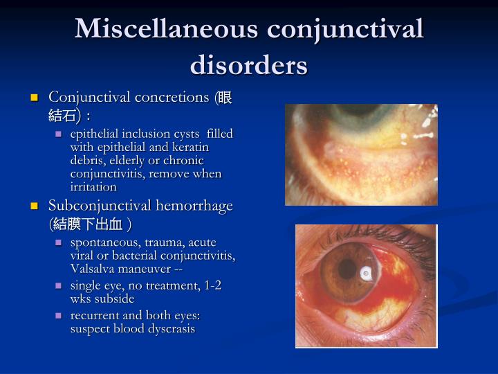 PPT - The Disease of Conjunctiva ( 結膜 ) /Sclera ( 鞏膜 ) PowerPoint ...
