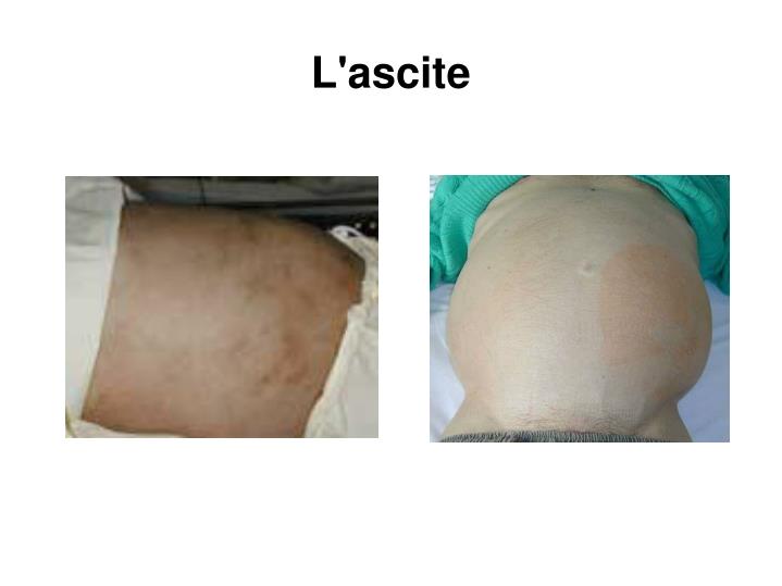 PPT - CIRROSI EPATICA PowerPoint Presentation - ID:3683194