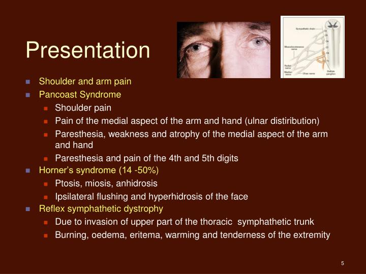 PPT - Superior Sulcus Tumors PowerPoint Presentation - ID:3686708