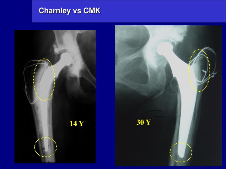 PPT - The Charnley Kerboull hip system Results of a 30 years experience ...