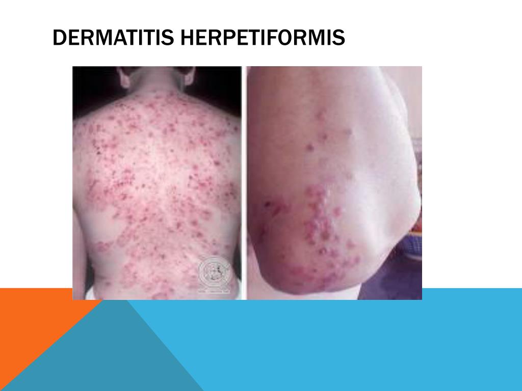 PPT - SKIN MANIFESTATIONS OF CELIAC DISEASE صــور د. إبراهيم الصيـــاد ...