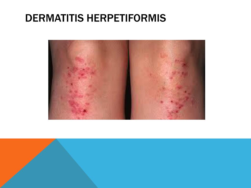 PPT - SKIN MANIFESTATIONS OF CELIAC DISEASE صــور د. إبراهيم الصيـــاد ...