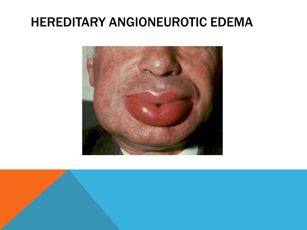PPT - SKIN MANIFESTATIONS OF CELIAC DISEASE صــور د. إبراهيم الصيـــاد ...