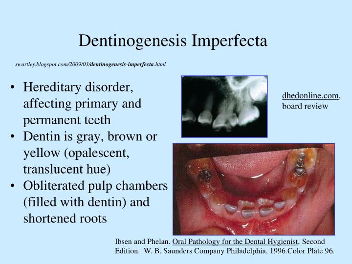 PPT - Dental Anomalies PowerPoint Presentation - ID:3700780