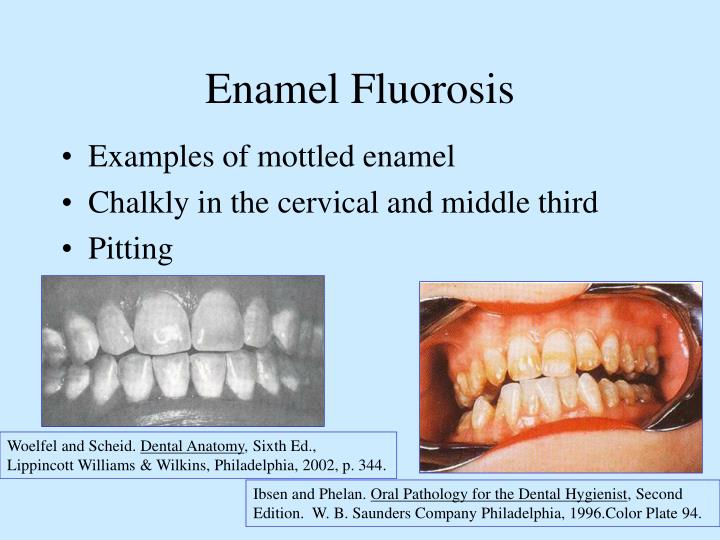 PPT - Dental Anomalies PowerPoint Presentation - ID:3700780