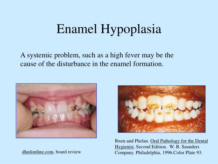 PPT - Dental Anomalies PowerPoint Presentation - ID:3700780