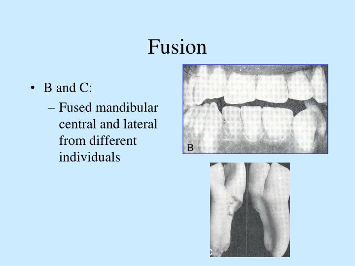 PPT - Dental Anomalies PowerPoint Presentation - ID:3700780