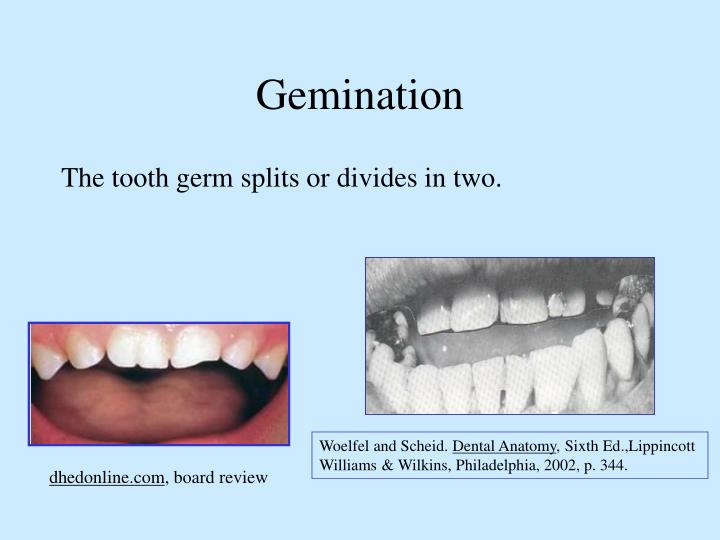 PPT - Dental Anomalies PowerPoint Presentation - ID:3700780