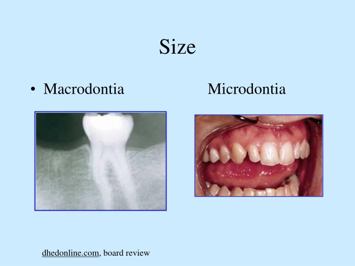 PPT - Dental Anomalies PowerPoint Presentation - ID:3700780