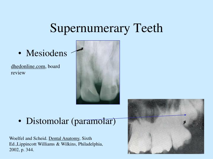 PPT - Dental Anomalies PowerPoint Presentation - ID:3700780