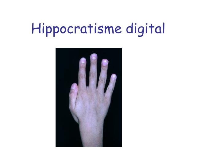 PPT - La Mucoviscidose PowerPoint Presentation - ID:3701224