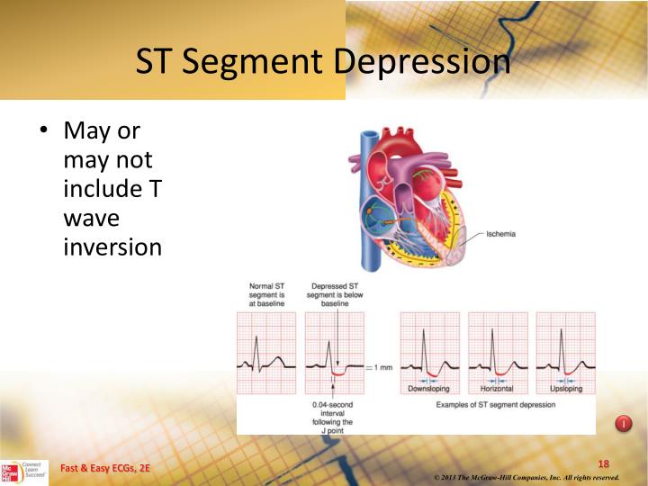 PPT - Myocardial Ischemia, Injury, and Infarction PowerPoint ...
