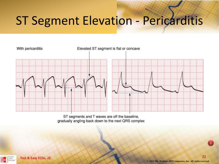 PPT - Myocardial Ischemia, Injury, and Infarction PowerPoint ...