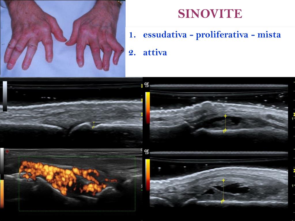 PPT - REUMATOLOGIA OGGI: segni, sintomi, diagnosi Sabato 23 maggio 2009 ...