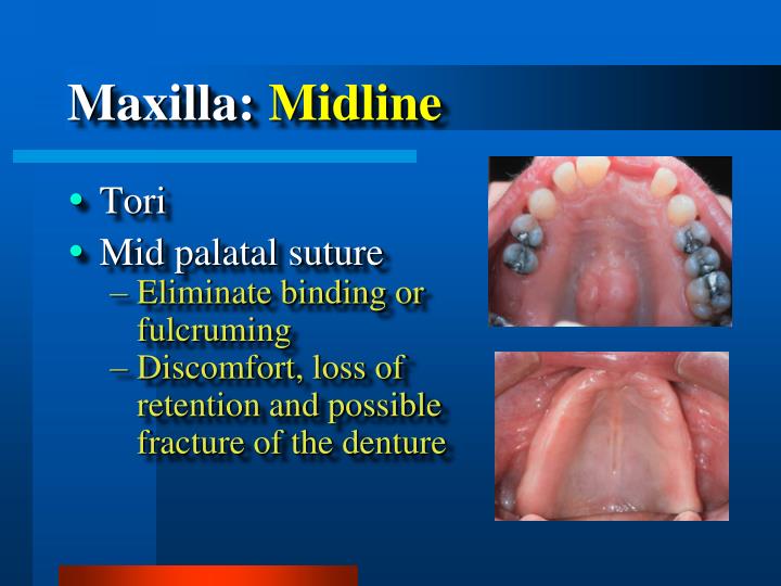 PPT - Complete Denture Diagnosis & Treatment Planning PowerPoint ...