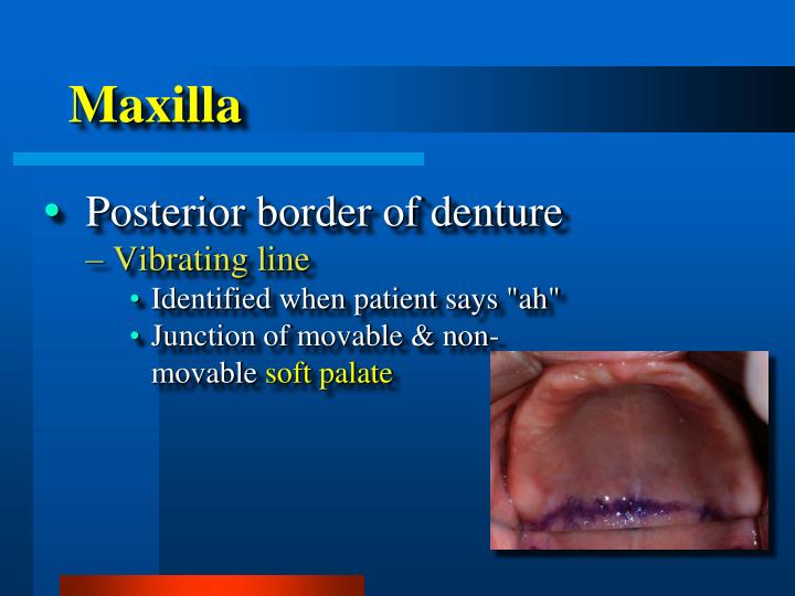 PPT - Complete Denture Diagnosis & Treatment Planning PowerPoint ...
