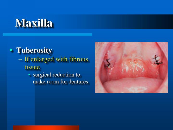PPT - Complete Denture Diagnosis & Treatment Planning PowerPoint ...