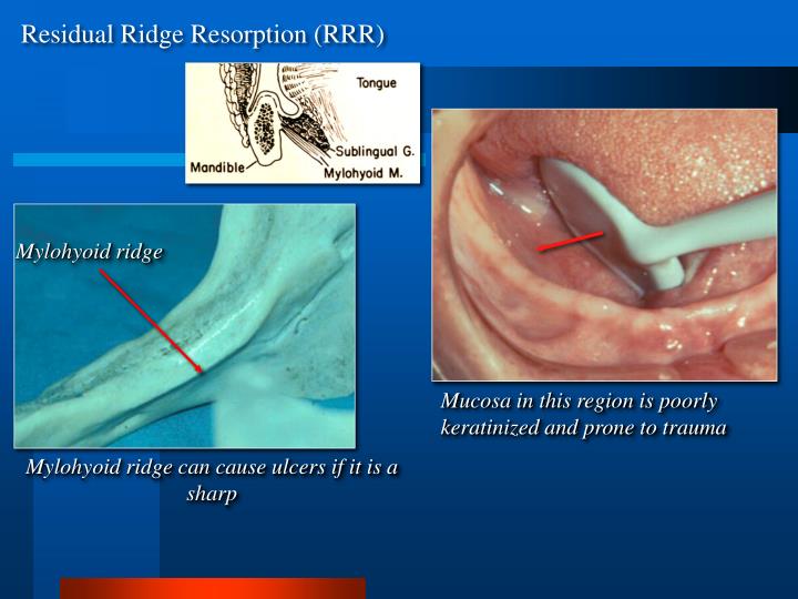PPT - Complete Denture Diagnosis & Treatment Planning PowerPoint ...