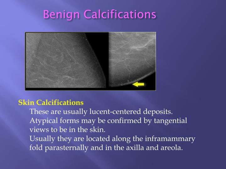 PPT - Breast Calcifications - Differential diagnosis and BIRADS ...