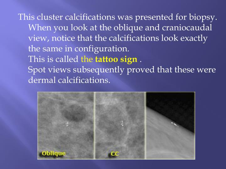PPT - Breast Calcifications - Differential diagnosis and BIRADS ...