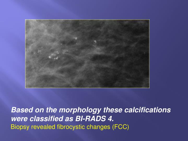 PPT - Breast Calcifications - Differential diagnosis and BIRADS ...